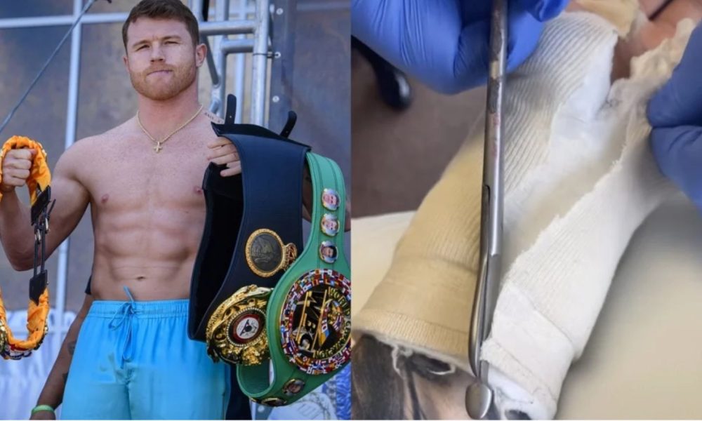 Así quedó la mano del Canelo Álvarez tras su cirugía - Punto MX